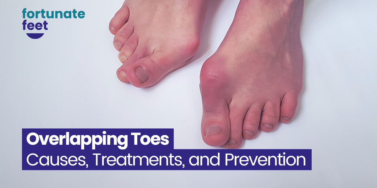 Overlapping Toes Causes Treatments And Prevention Fortunate Feet
